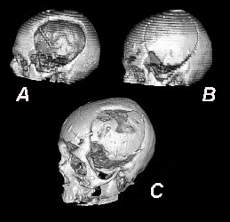 Cranioplasty : Routine Surgical Procedure or Risky Operation? - World ...
