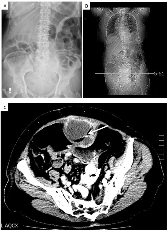 Colovesical fish bone perforation in a 94 year old lady - World Journal ...