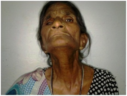 Metastatic follicular carcinoma of thyroid mimicking primary bone tumor ...